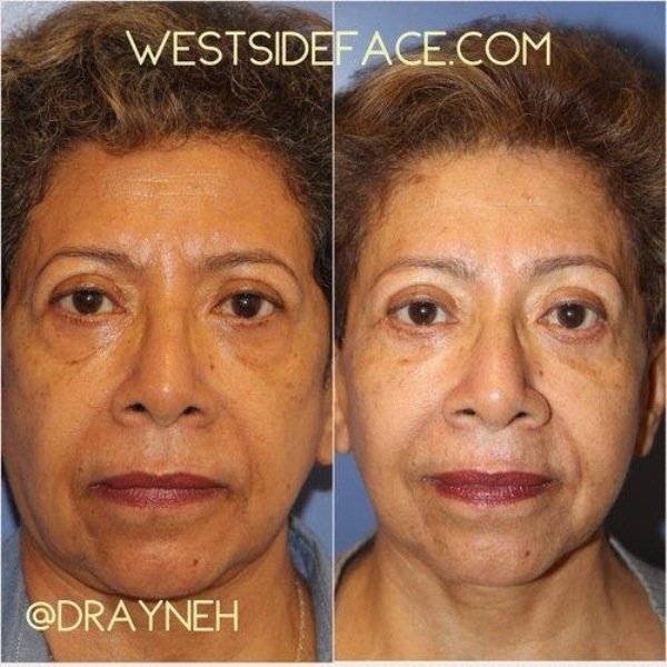 Know all about Brow Surgery » Residence Style